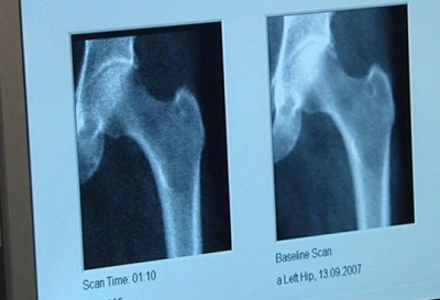 Santé : Voici comment éviter les maladies des os - Actualités ...